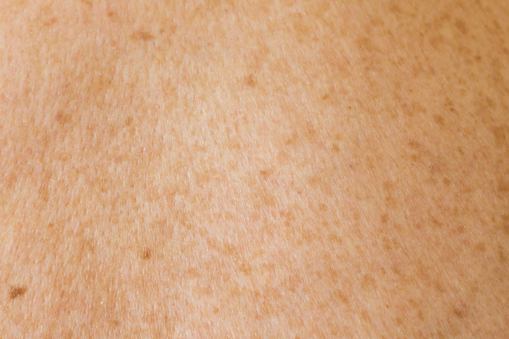 What is a skin graft? - Centre of the Cell
